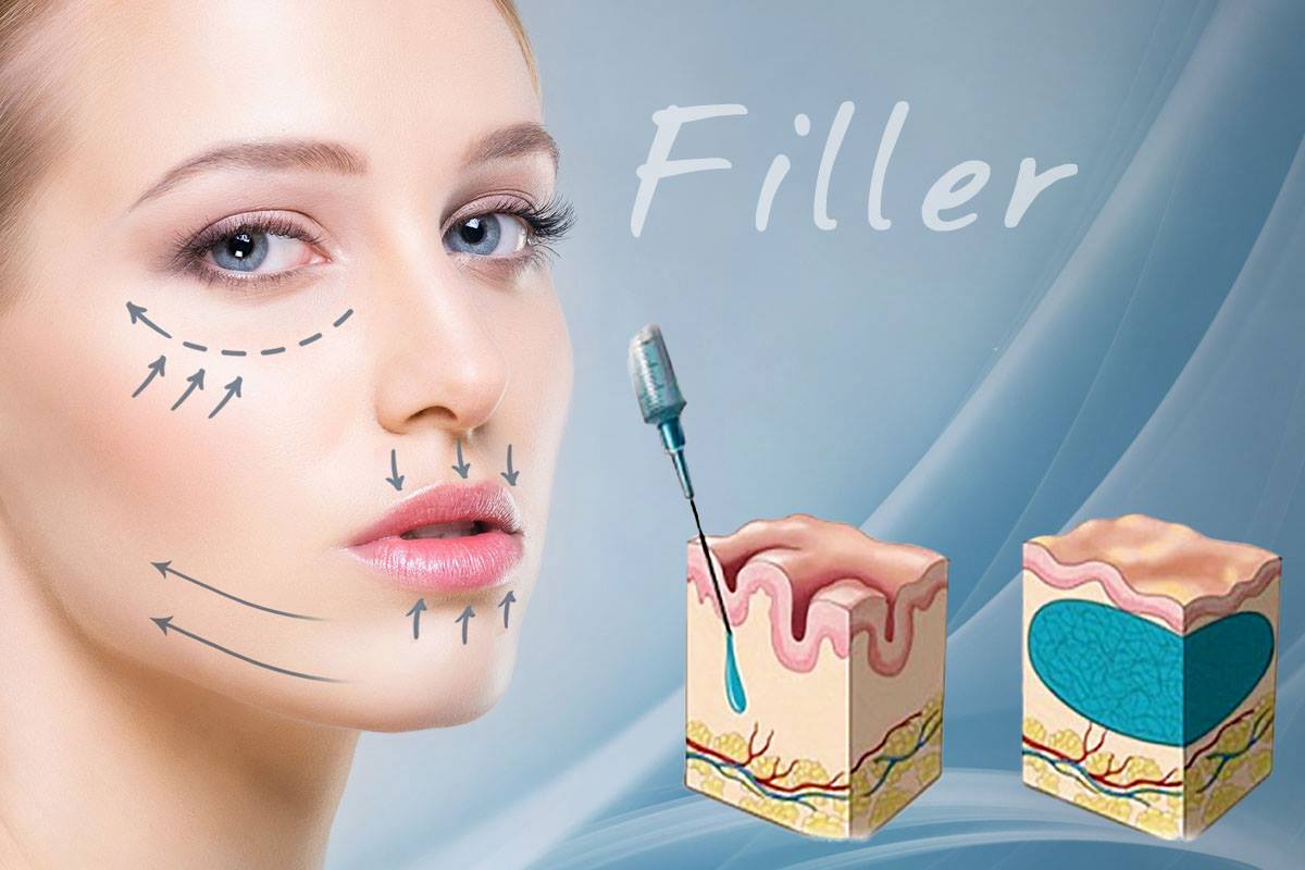 Filler - Clinica Merli • Dentisti Rimini | Morciano di Romagna | Forlì