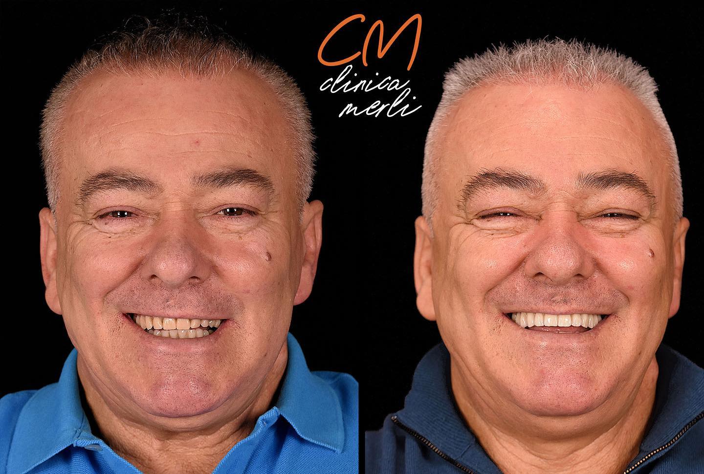 Il sorriso di Giovanni - Clinica Merli • Dentisti Rimini | Morciano di ...